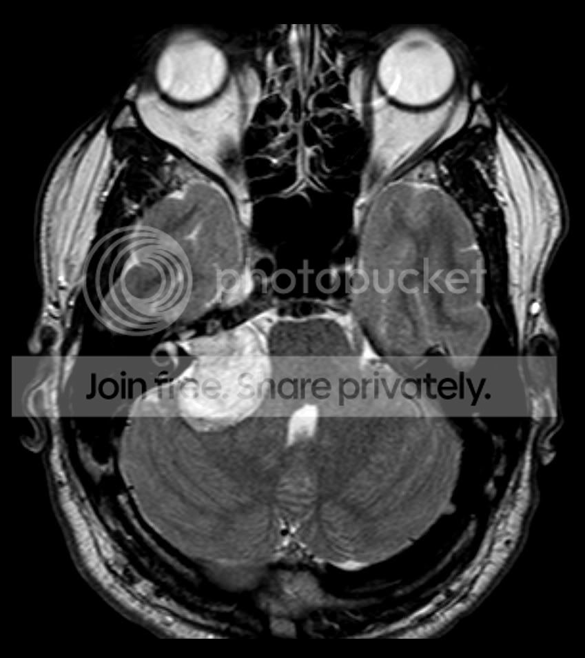 Will an Acoustic Neuroma show up on a CT scan?